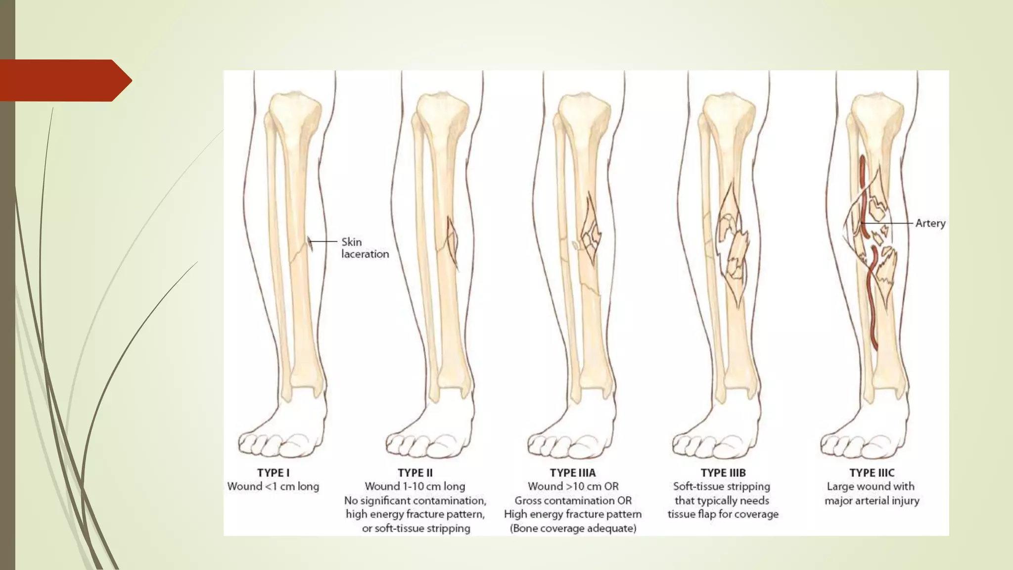 Open fractures | PPT