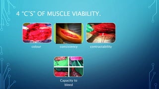 COMPOUND FRACTURES.pptx