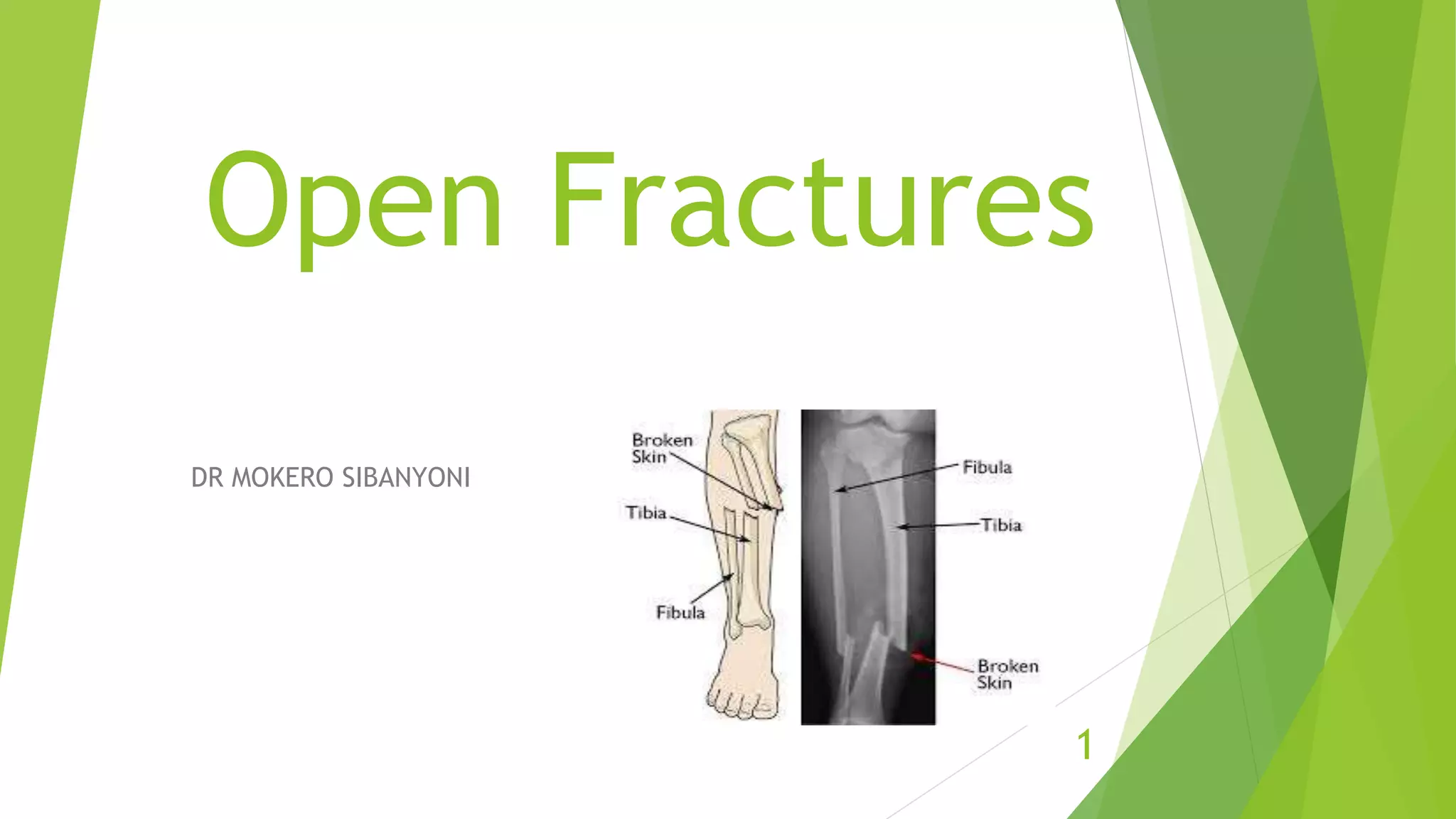 OPEN FRACTURES.pptx