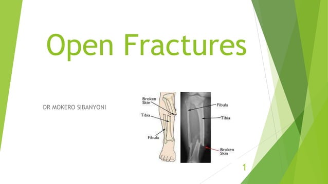 OPEN FRACTURES.pptx
