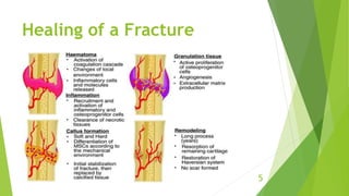 OPEN FRACTURES.pptx