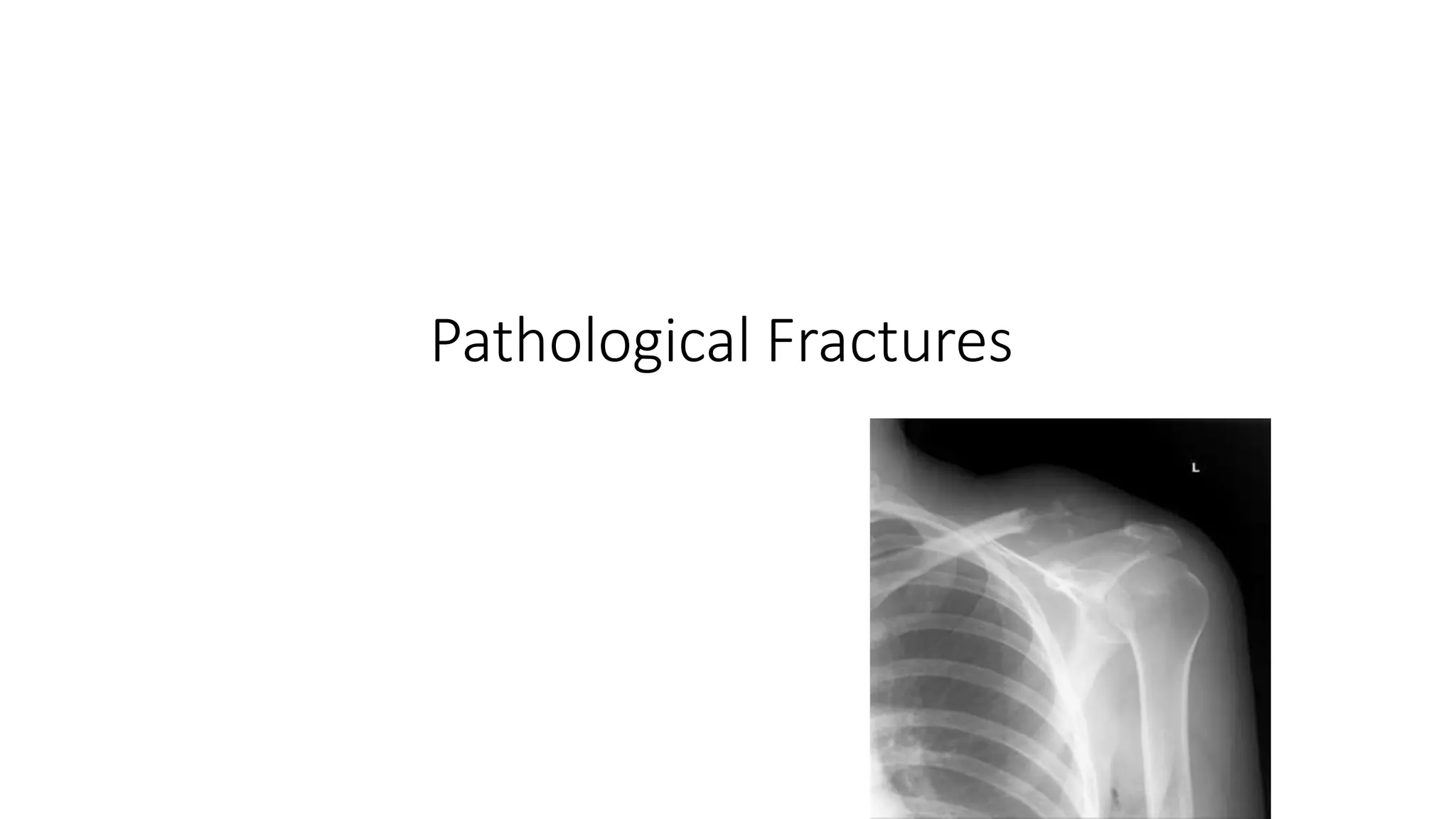 Management of Open Fractures and Pathological Fractures | PPTX