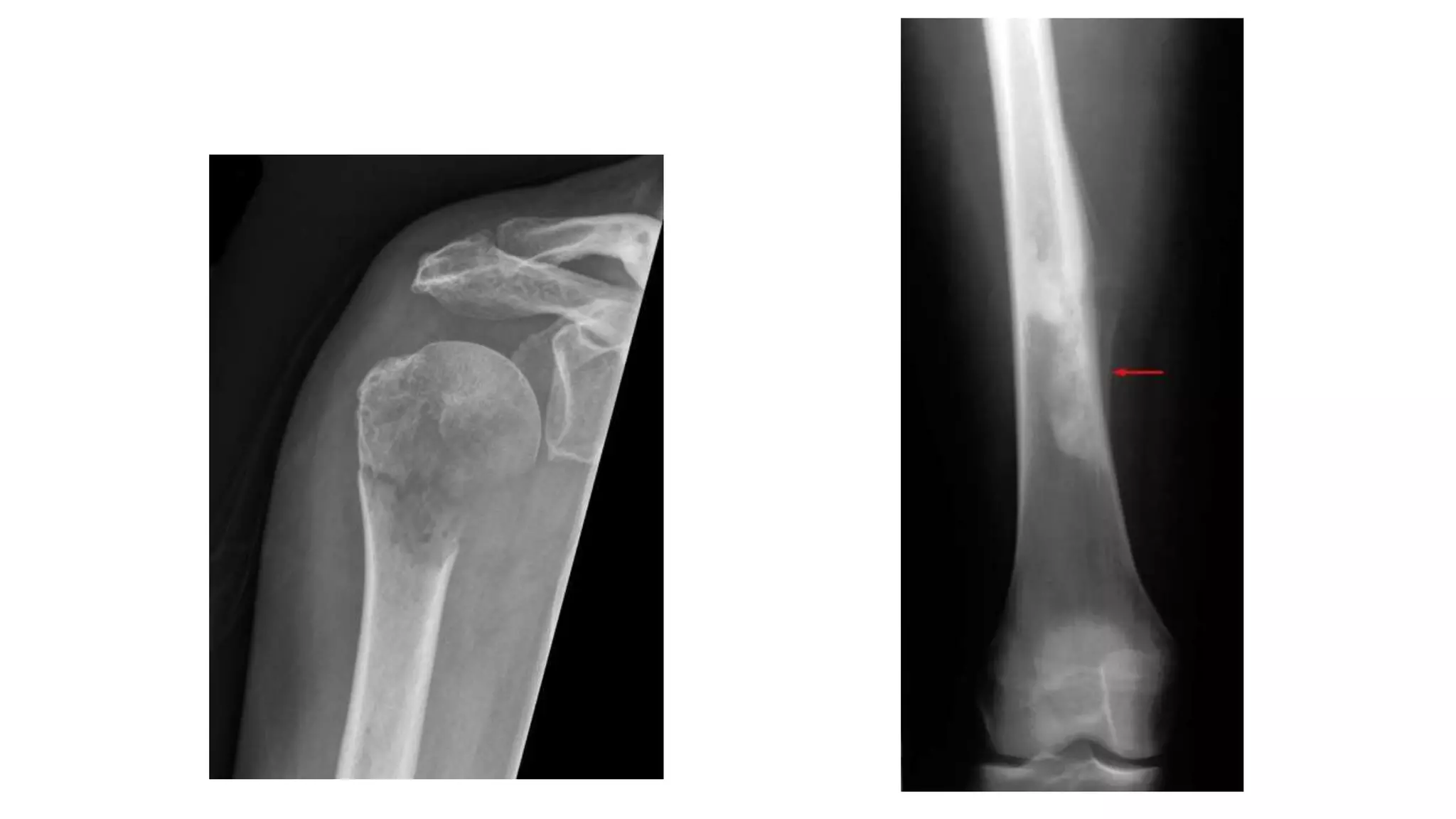 Management of Open Fractures and Pathological Fractures | PPTX