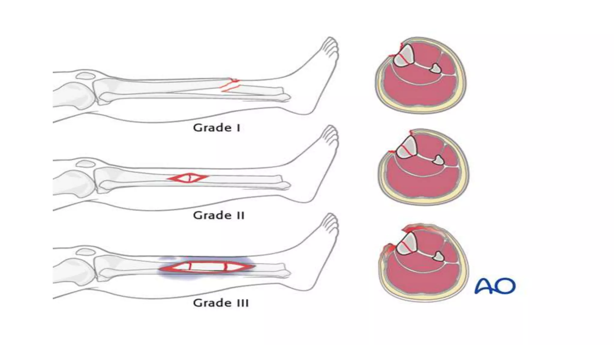 Management of Open Fractures and Pathological Fractures | PPTX