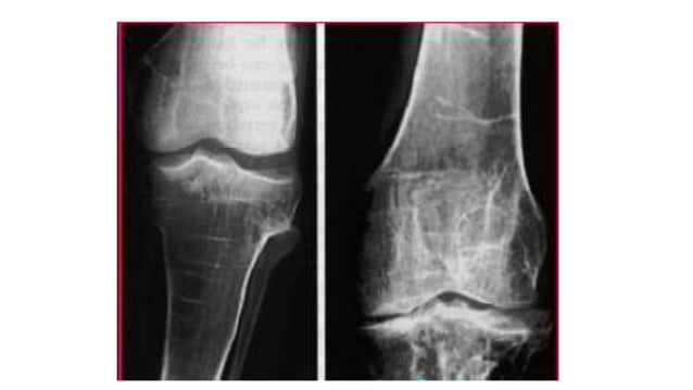 Management of Open Fractures and Pathological Fractures | PPT