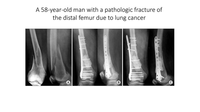 Management of Open Fractures and Pathological Fractures | PPT