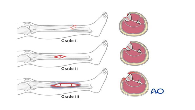 Management of Open Fractures and Pathological Fractures | PPT