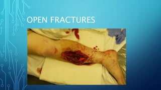 Open Fractures.pptx