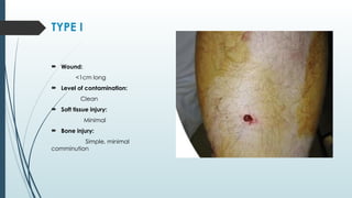 Open Fractures ,Classifications, ATLS, Management .pptx