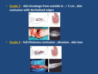 EVALUATION AND MANAGEMENT OF OPEN FRACTURE | PPTX