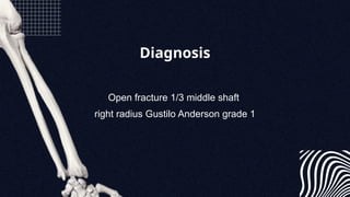 POWERPOINT Open Fracture Shaft Radius RSPTN | PPTX