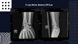 POWERPOINT Open Fracture Shaft Radius RSPTN | PPTX