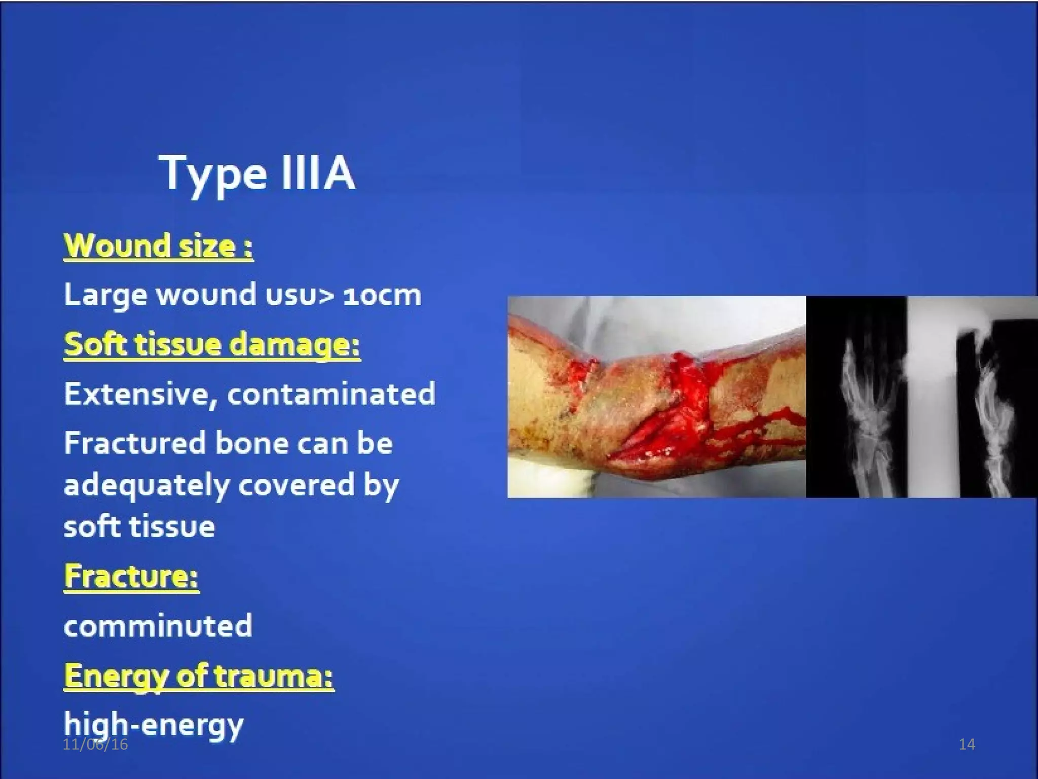 Open Fractures Classification and Management. | PPT