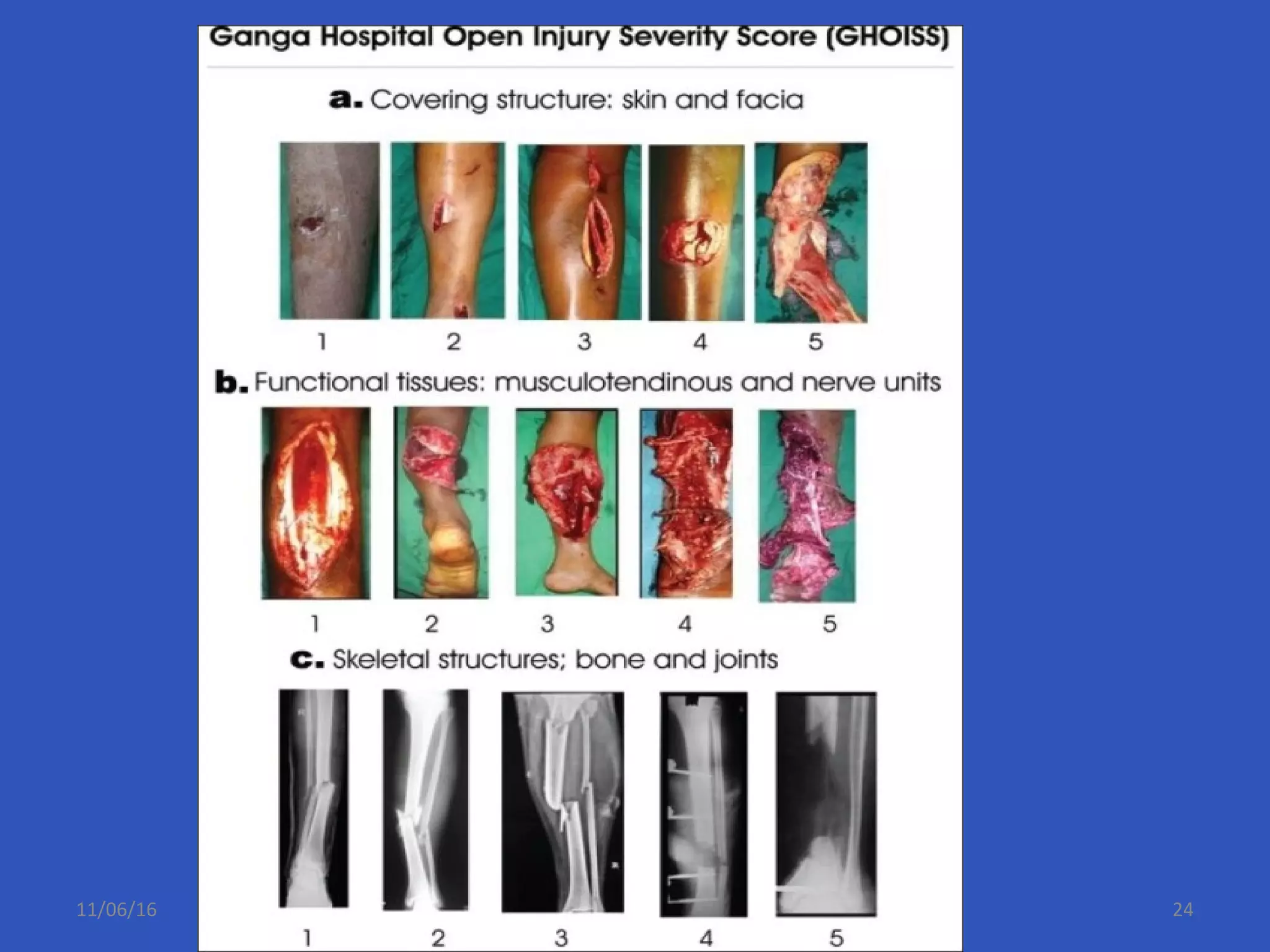 Open Fractures Classification And Management Ppt
