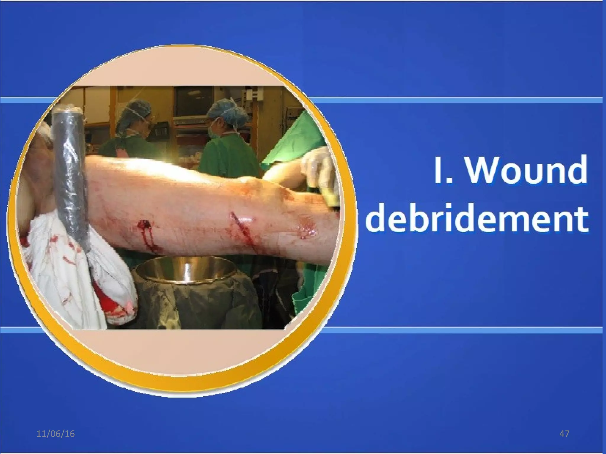 Open Fractures Classification and Management. | PPT