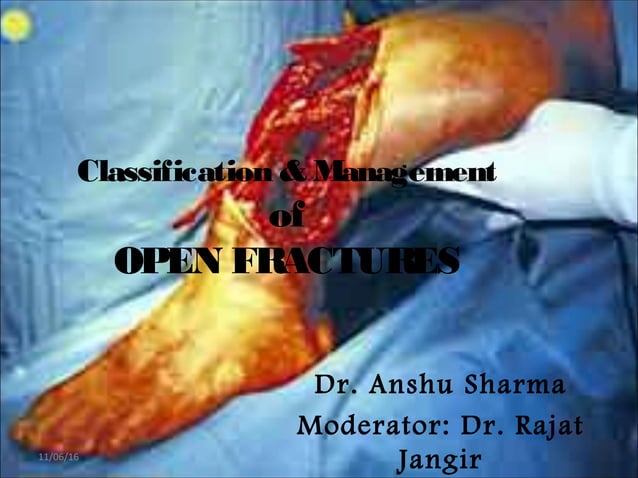 Open Fractures Classification and Management. | PPT