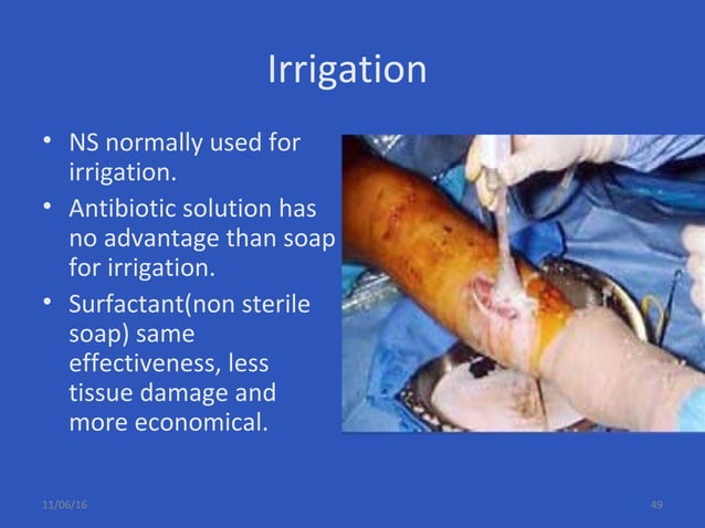 Open Fractures Classification and Management. | PPT