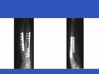 Open Fractures Classification and Management. | PPT