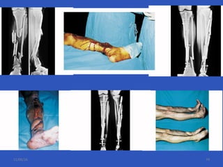 Open Fractures Classification and Management. | PPT