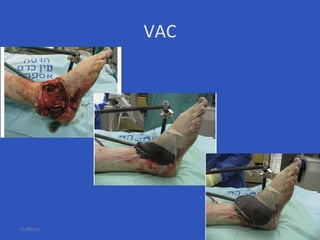 Open Fractures Classification and Management. | PPT