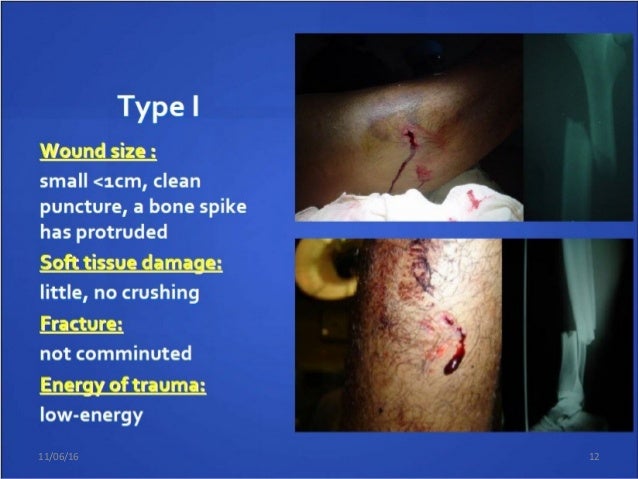 Open Fractures Classification and Management.
