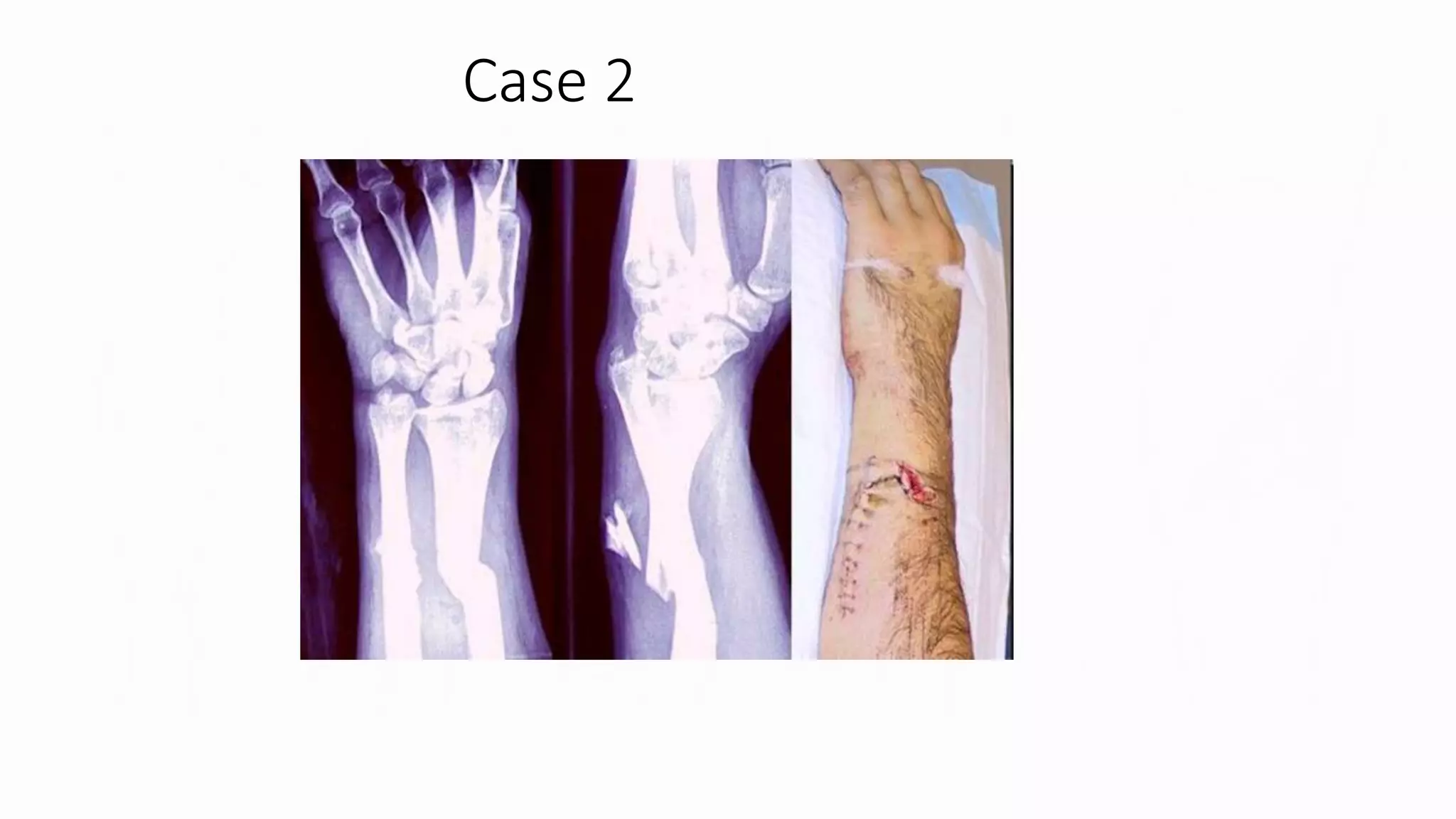 Open fractures ppt | PPTX