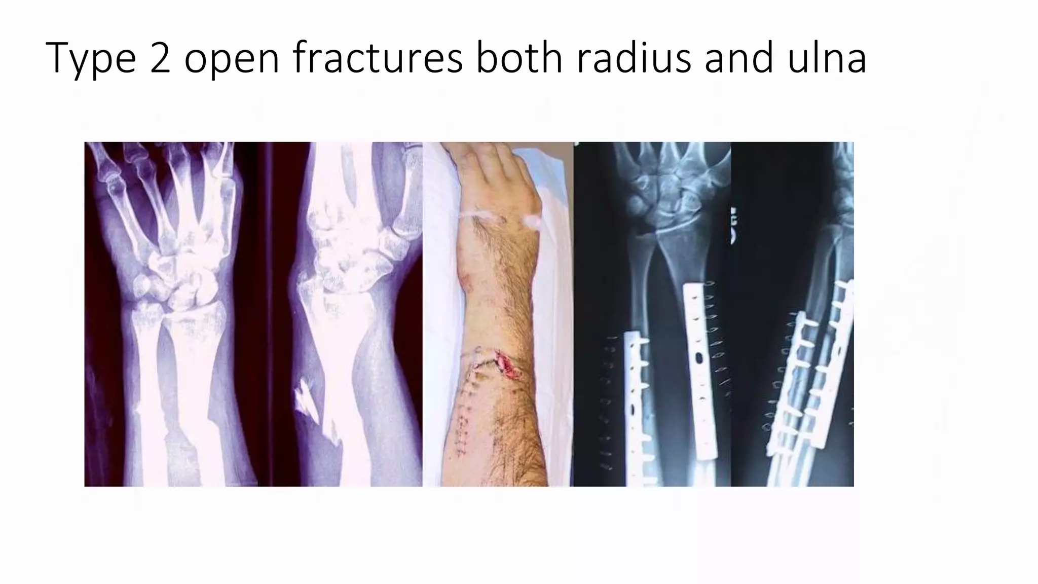 Open fractures ppt | PPTX