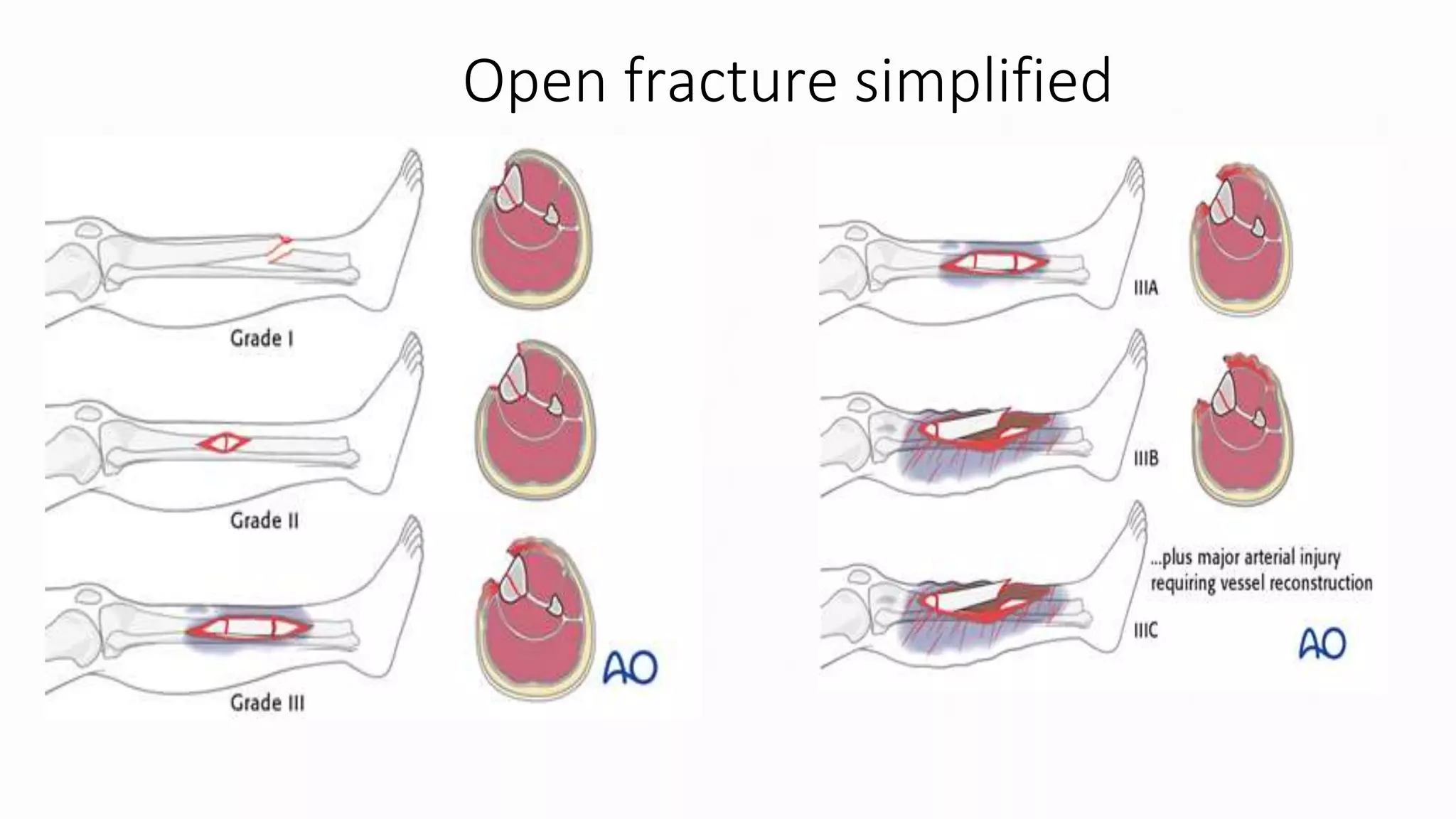 Open fractures ppt | PPTX