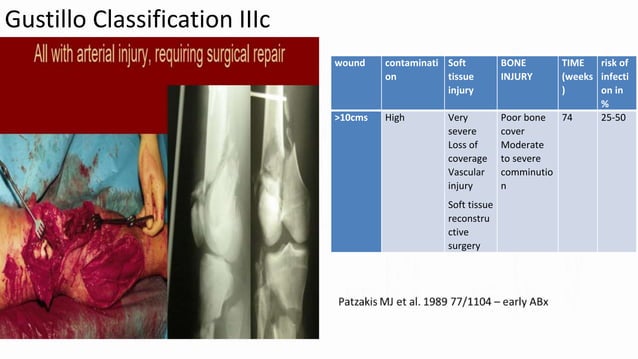 Open fractures ppt | PPTX | First Aid | Injuries