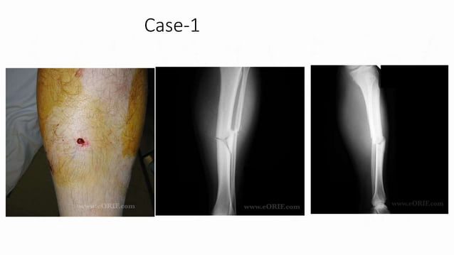 Open fractures ppt | PPTX | First Aid | Injuries