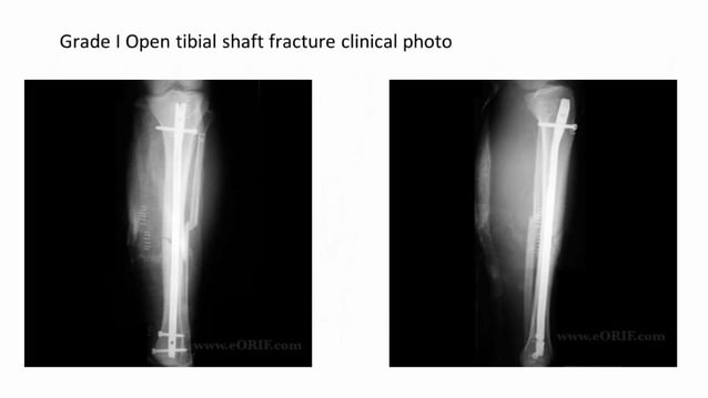 Open fractures ppt | PPTX | First Aid | Injuries