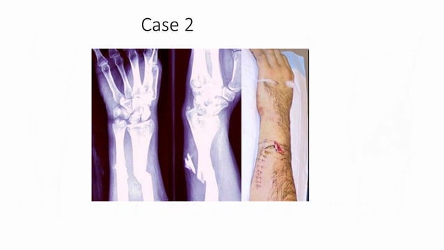 Open fractures ppt | PPTX | First Aid | Injuries