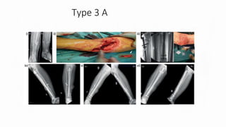 Open fractures ppt | PPTX