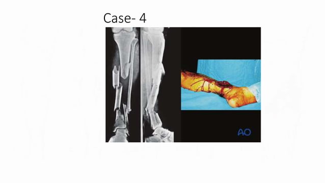 Open fractures ppt | PPTX | First Aid | Injuries
