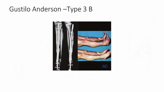 Open fractures ppt | PPTX | First Aid | Injuries