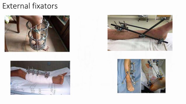 Open fractures ppt | PPTX | First Aid | Injuries