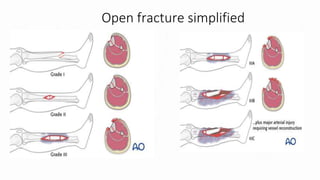 Open fractures ppt | PPTX