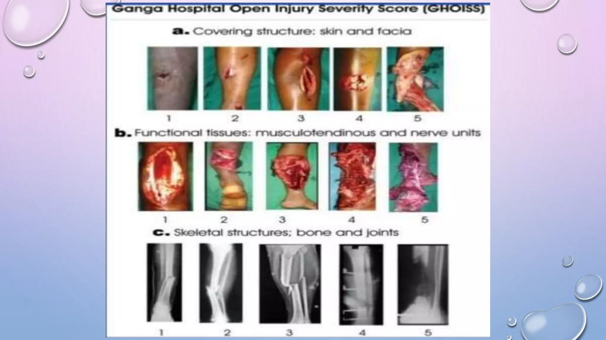Open fractures Punit | PPT
