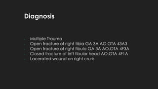 Open Fraktur Tibia Fibulae - Julang ENGLISH.pptx