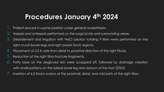 Open Fraktur Tibia Fibulae - Julang ENGLISH.pptx