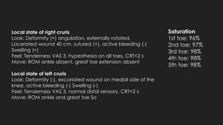 Open Fraktur Tibia Fibulae - Julang ENGLISH.pptx
