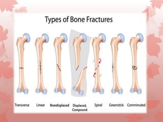 Linear Bone Fracture
