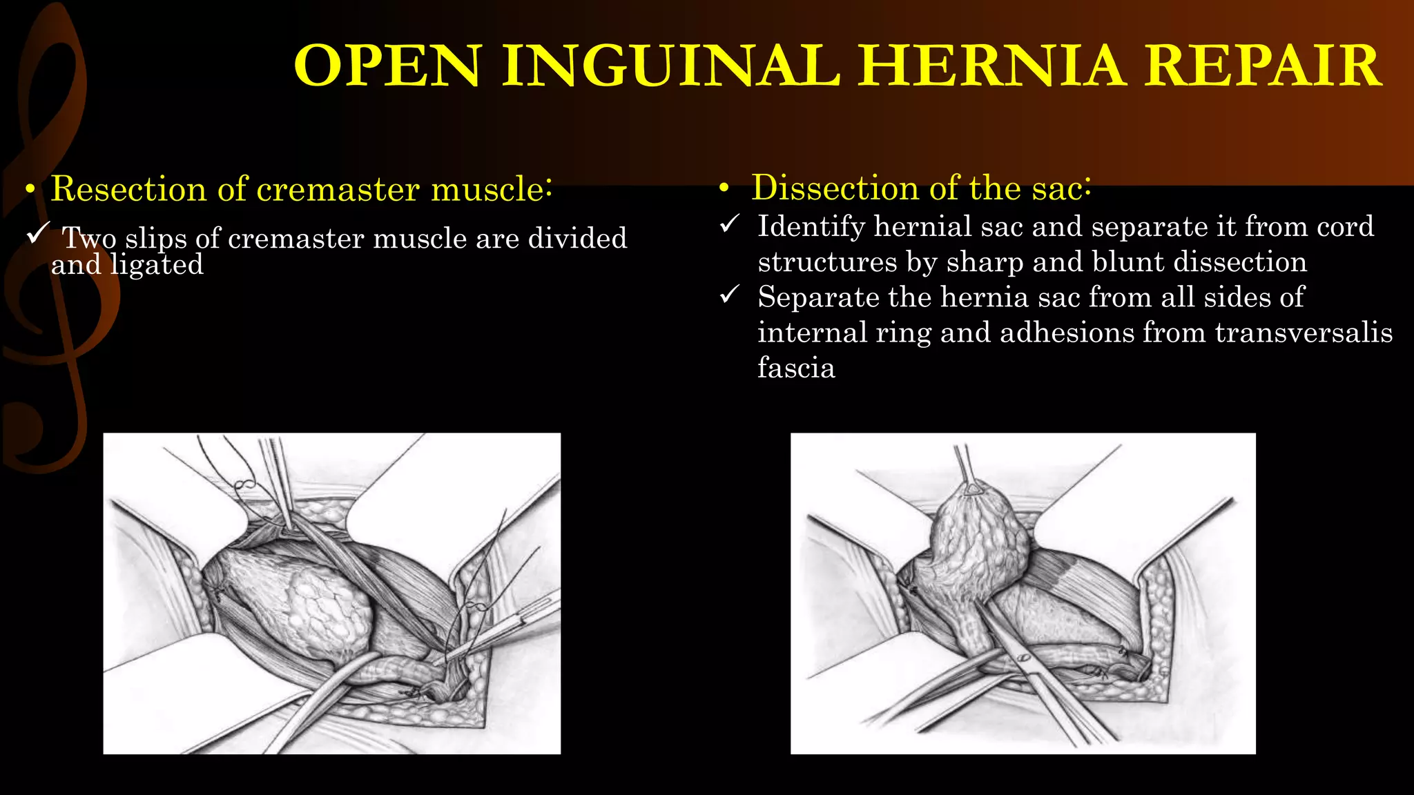 Open inguinal hernia repair / operative surgery | PPTX