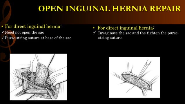 Open inguinal hernia repair / operative surgery | PPTX