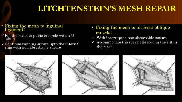 Open inguinal hernia repair / operative surgery