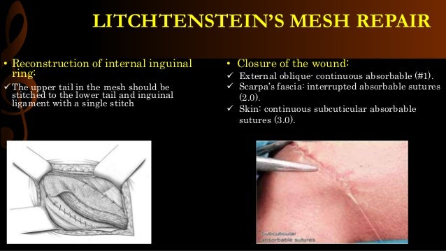 Open inguinal hernia repair / operative surgery