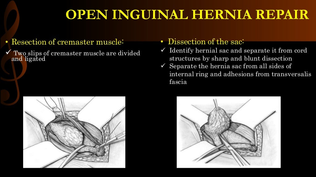 Open inguinal hernia repair / operative surgery