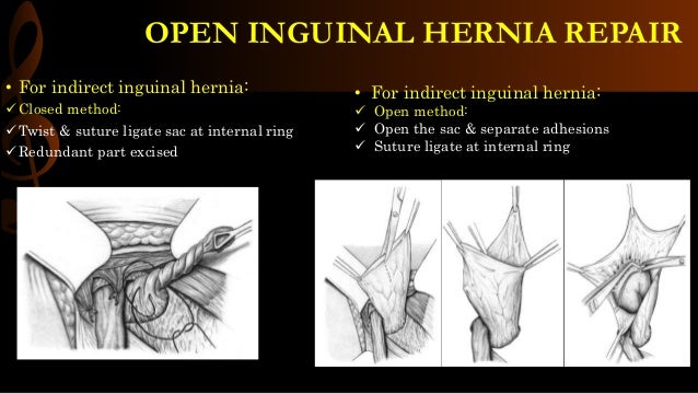 Open inguinal hernia repair / operative surgery