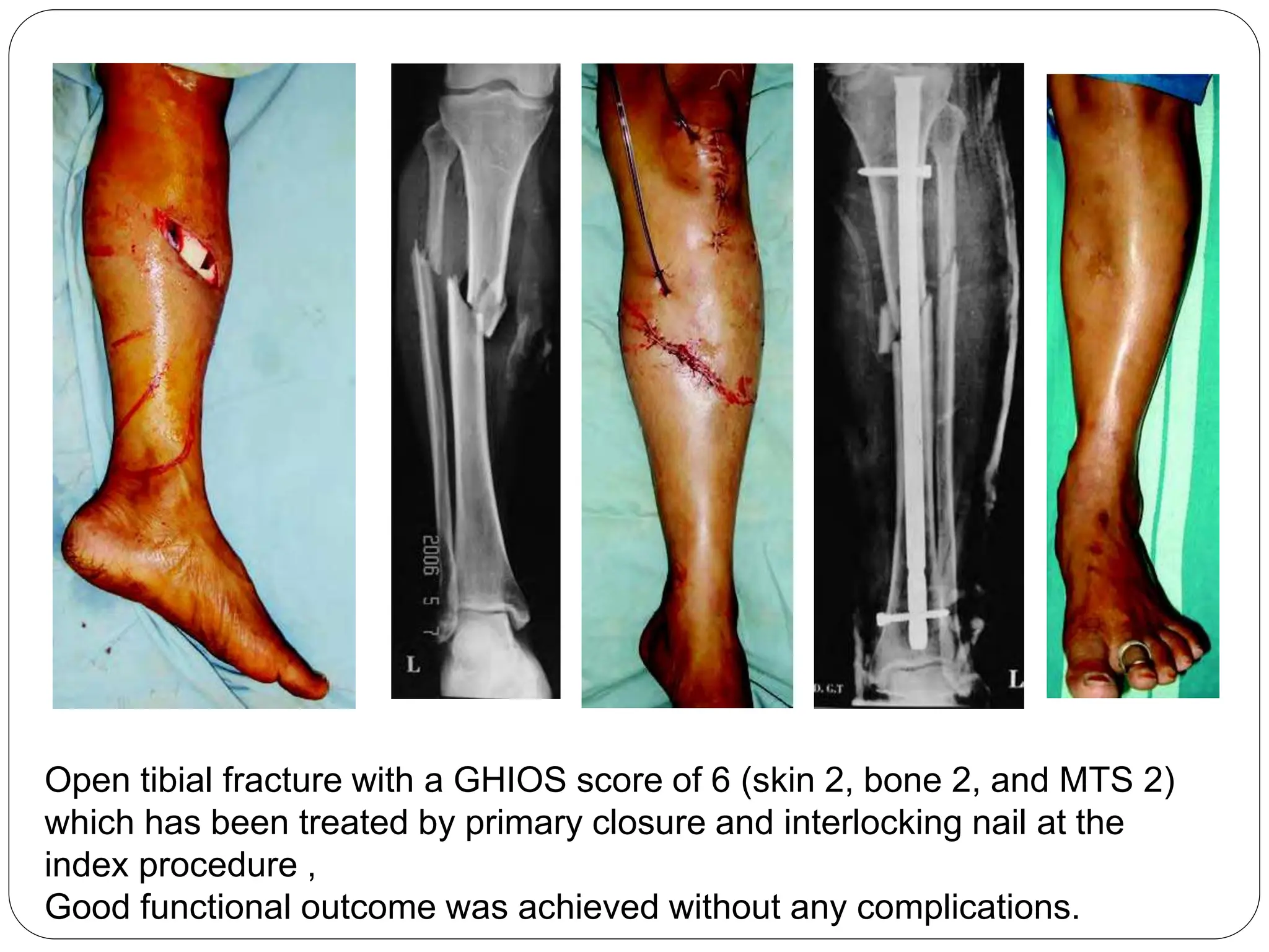 open injury and open fracture management | PPT