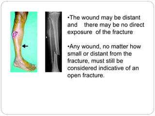 open injury and open fracture management | PPTX